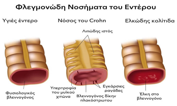Συζητώντας για την ελκώδη κολίτιδα και τη νόσο του Crohn - Τα Νέα της ...