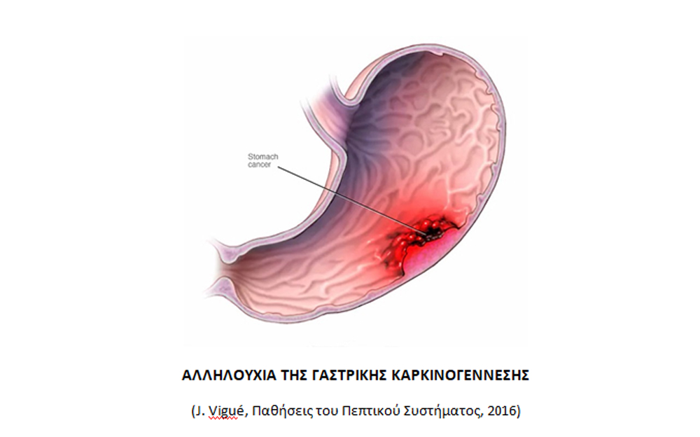 ΚΑΡΚΙΝΟΣ ΤΟΥ ΣΤΟΜΑΧΟΥ: «Κάλλιον τοu θεραπεύειν το προλαμβάνειν»